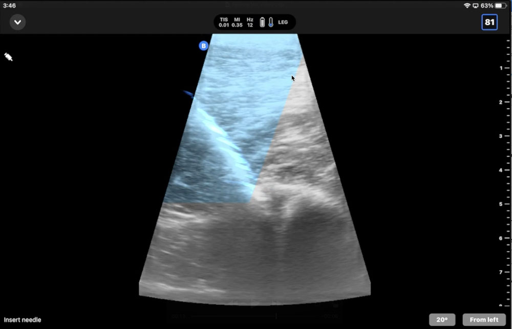 Butterfly Ultrasound Tips: Ultrasound-Guided Injections - EquiManagement